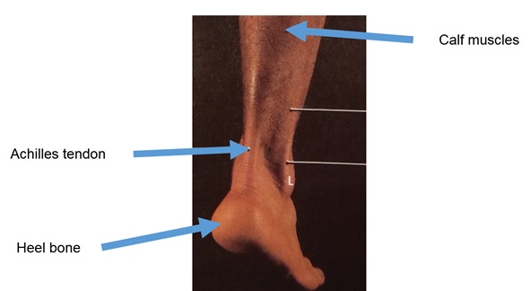 Achilles Tendonitis 阿基里斯腱炎 | Q9 Orthopaedic and Spine Centre