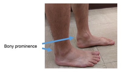 Achilles Tendonitis 阿基里斯腱炎 | Q9 Orthopaedic and Spine Centre