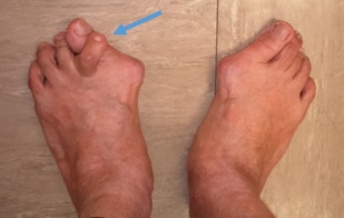 Hallux Valgus 拇趾外翻 | Q9 Orthopaedic and Spine Centre